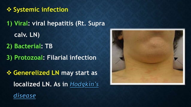 lymphadenopathy.pptx