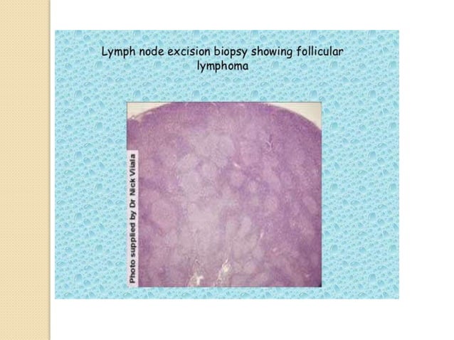 Lymphadenopathy approach