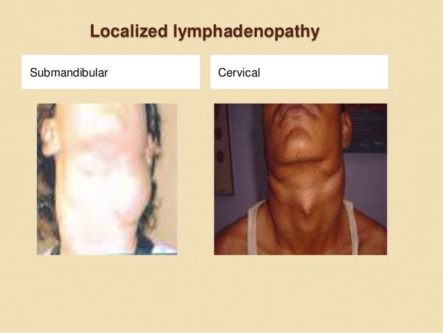 Lymphadenopathy approach