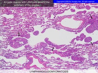 LYMPHANGIOLEIOMYOMATOSIS | PPS