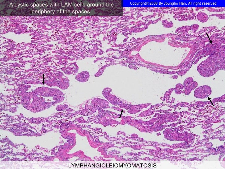 LYMPHANGIOLEIOMYOMATOSIS