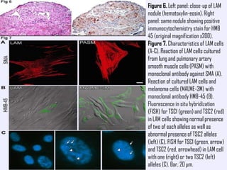 Lymphangioleiomyomatosis | PPTX