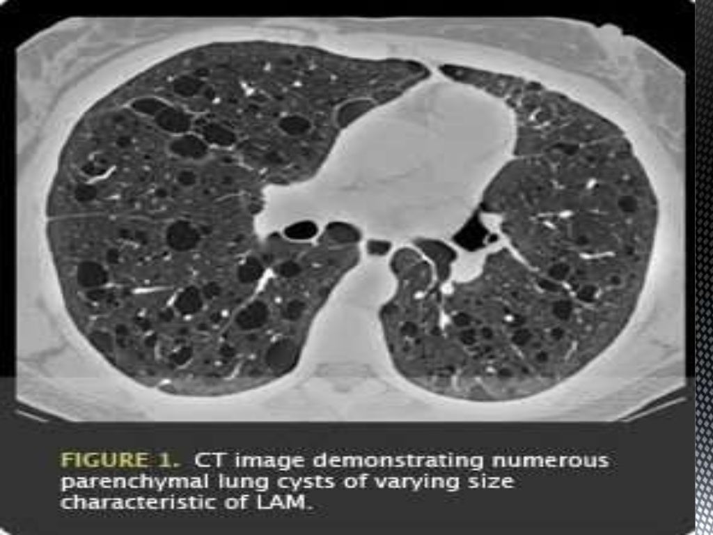 Lymphangioleiomyomatosis