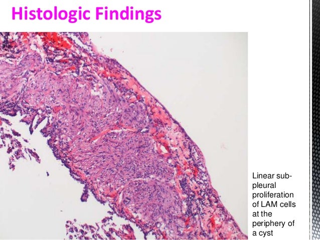 Lymphangioleiomyomatosis