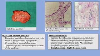 LYMPHANGIOMA.pptx