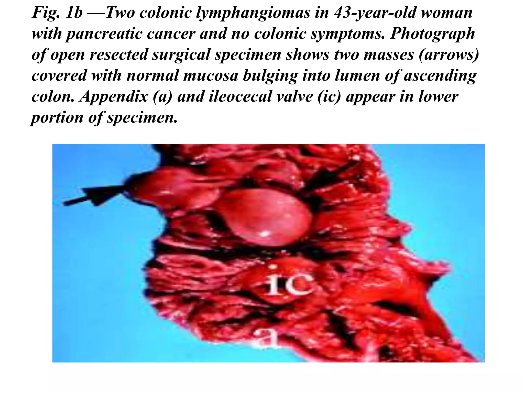 Lymphangioma in small bowel disease | PPTX