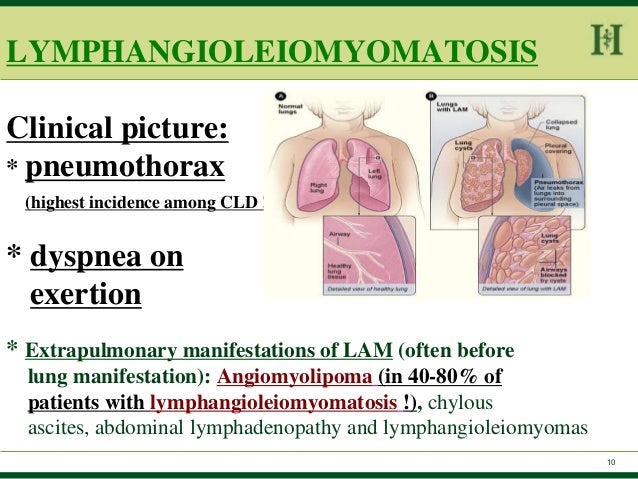Lymphangiomyomatosis presentation dr. med. i. nenadic
