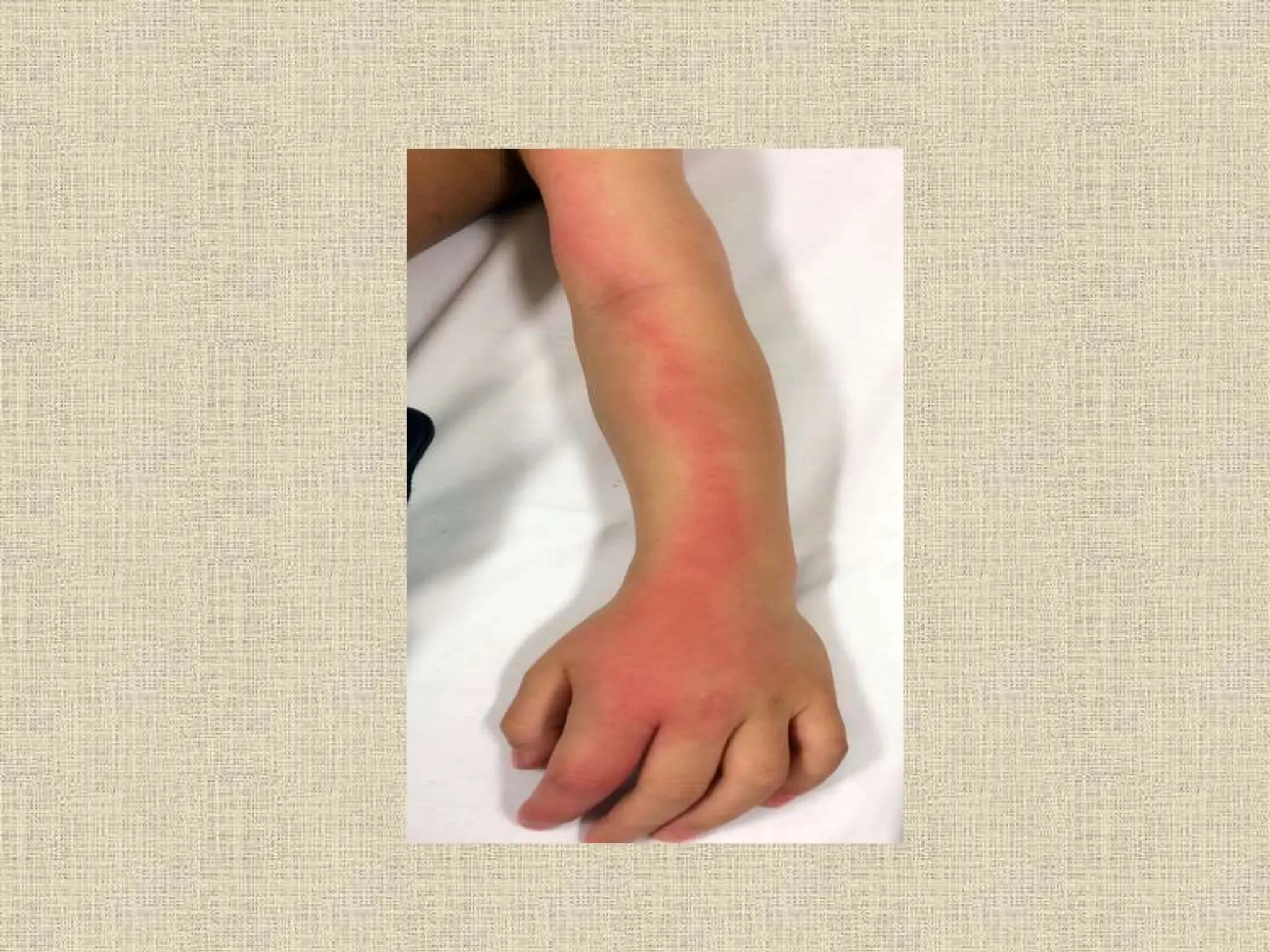 Lymphangitis-1.pptx physiotherapy ppt general surgery | PPTX