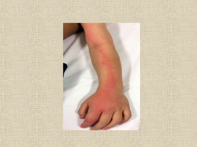 Lymphangitis-1.pptx physiotherapy ppt general surgery | PPT