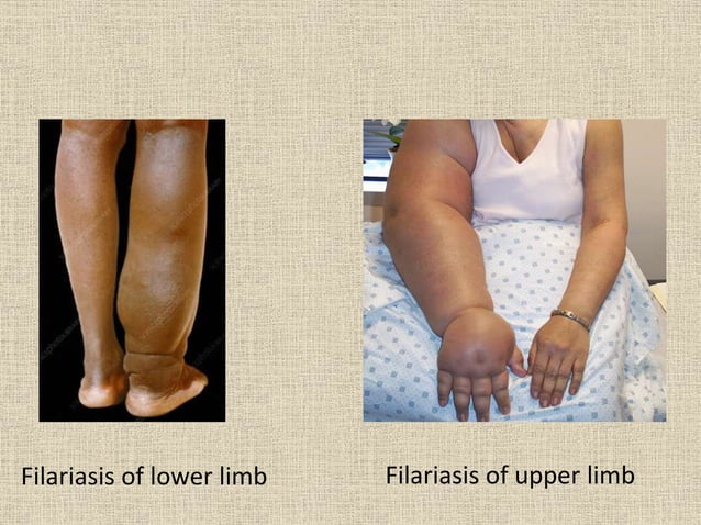 Lymphangitis-1.pptx physiotherapy ppt general surgery | PPT