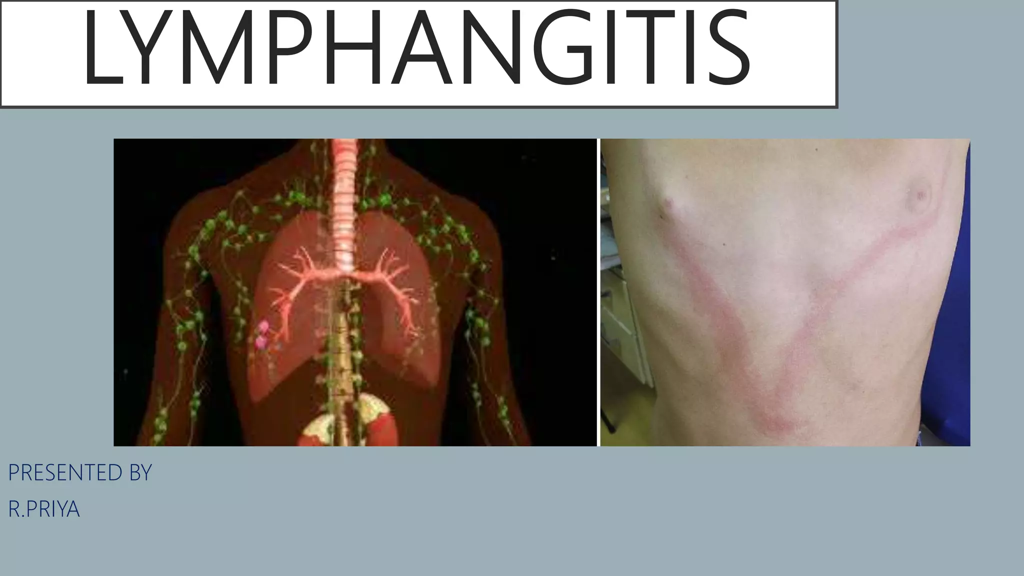 Lymphangitis | PPTX