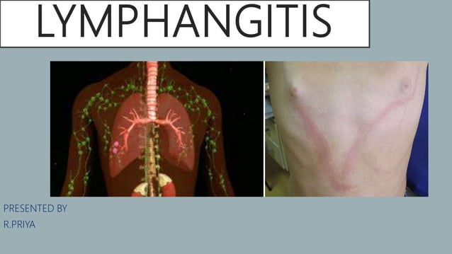 Lymphangitis | PPTX