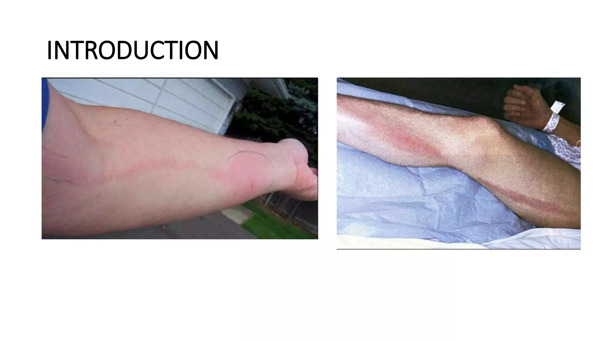 LYMPHANGITIS and lymphoedema.pptx