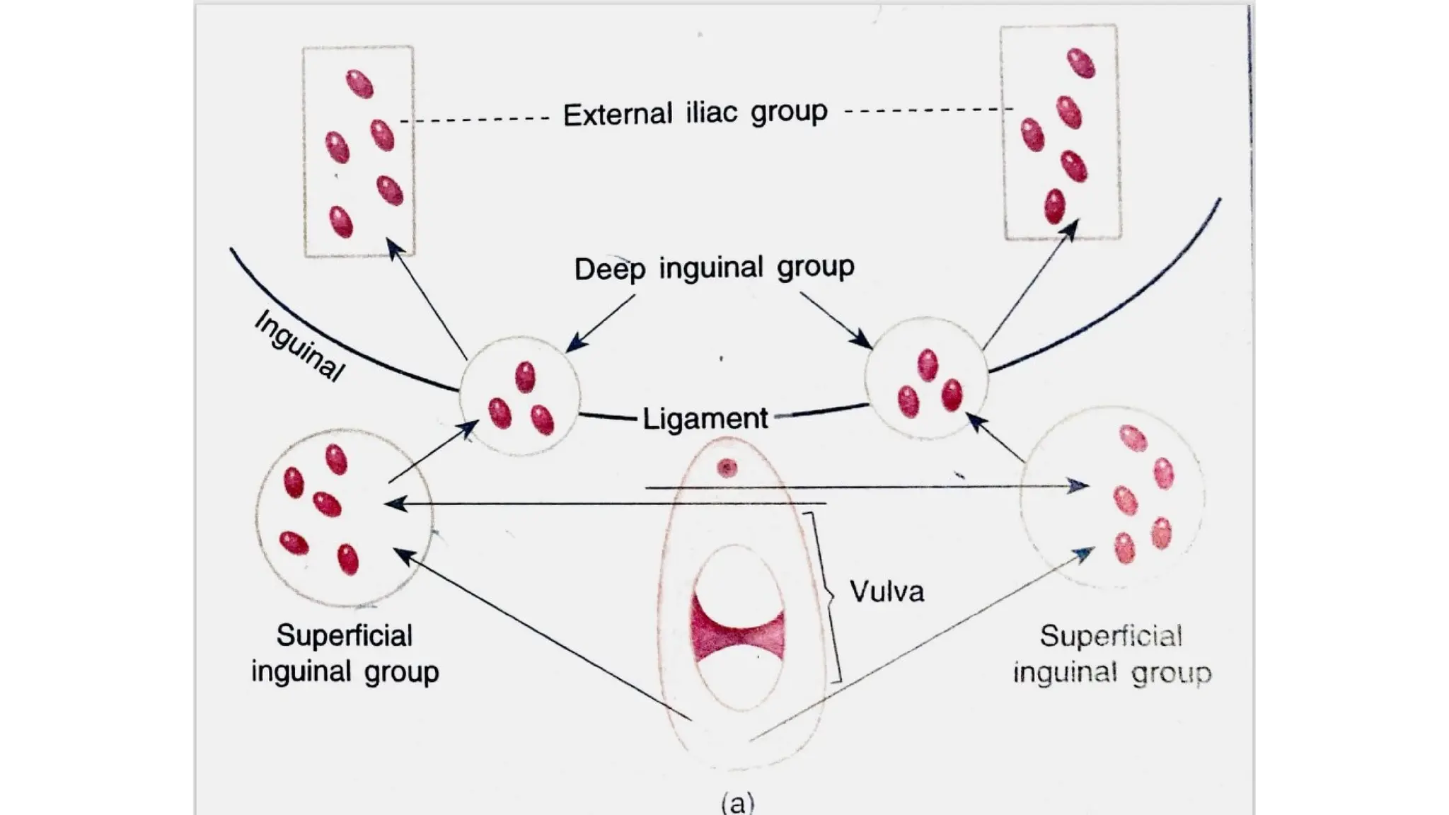 Lymphatic drainage of female genital tract.pptx