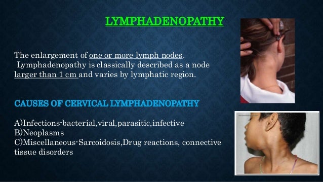 What are shotty lymph nodes - tblery