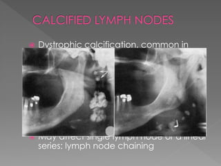 Lymphatic drainage of the head and neck | PDF
