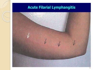 Lymphatic filariasis | PPT