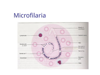 Lymphatic filariasis clinical disease , labdiagnosis and treatment | PPTX