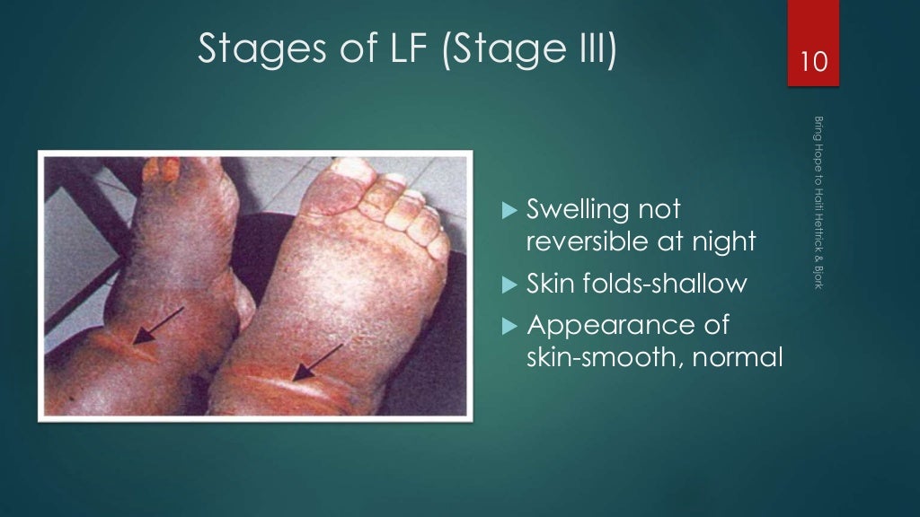 Lymphatic filariasis ppt 1014