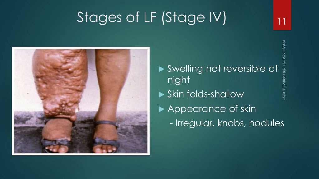 Lymphatic filariasis ppt 1014