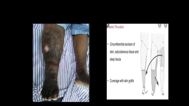 Lymphatic pathophysiology | PPT