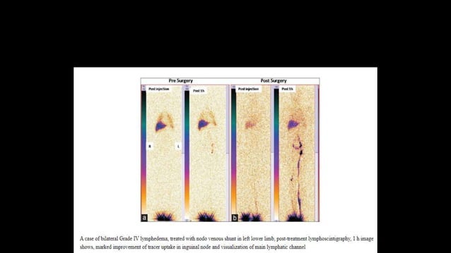 Lymphatic pathophysiology | PPTX | Biological Sciences | Science