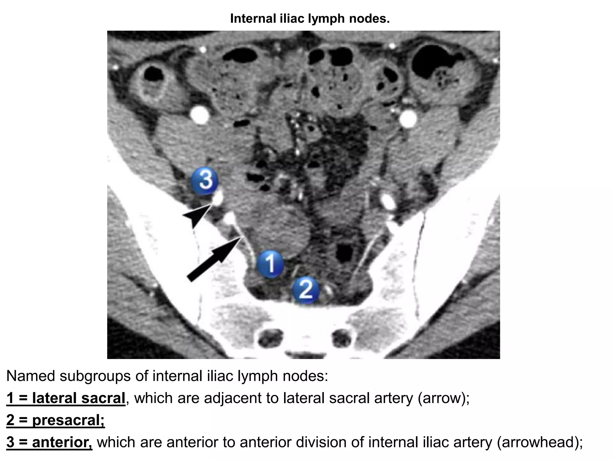 Lymphatics of the pelvis | PPTX