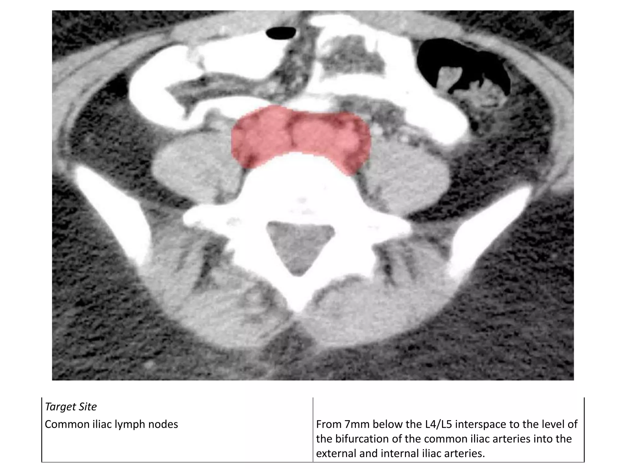 Lymphatics of the pelvis | PPTX