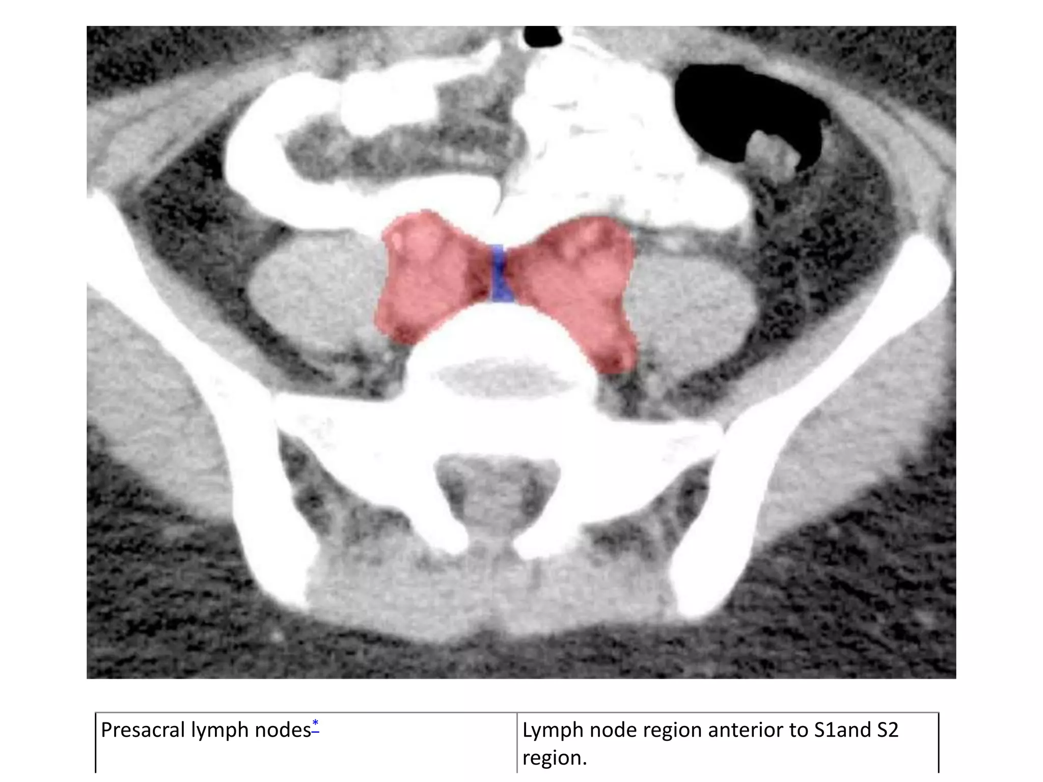 Lymphatics of the pelvis | PPTX