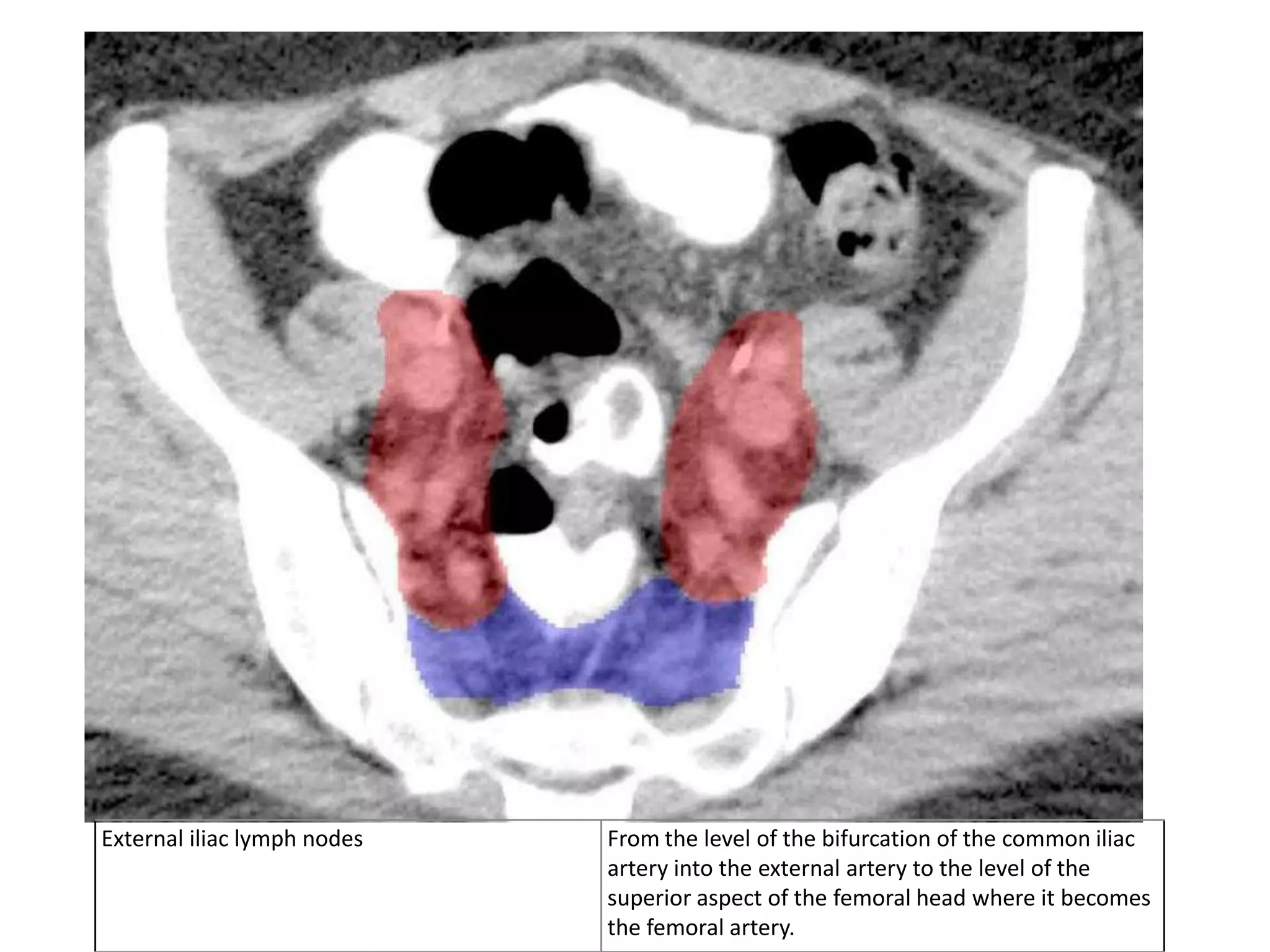 Lymphatics of the pelvis | PPTX