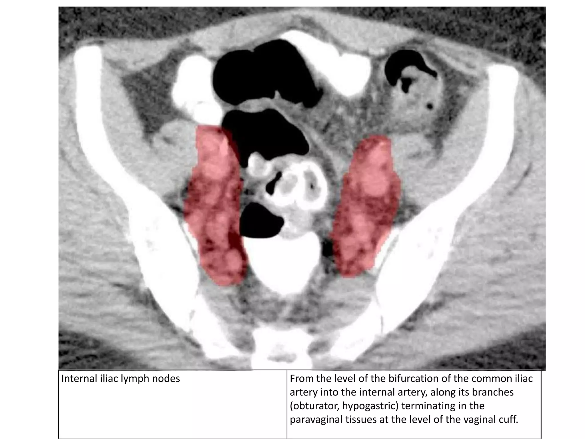 Lymphatics of the pelvis | PPTX