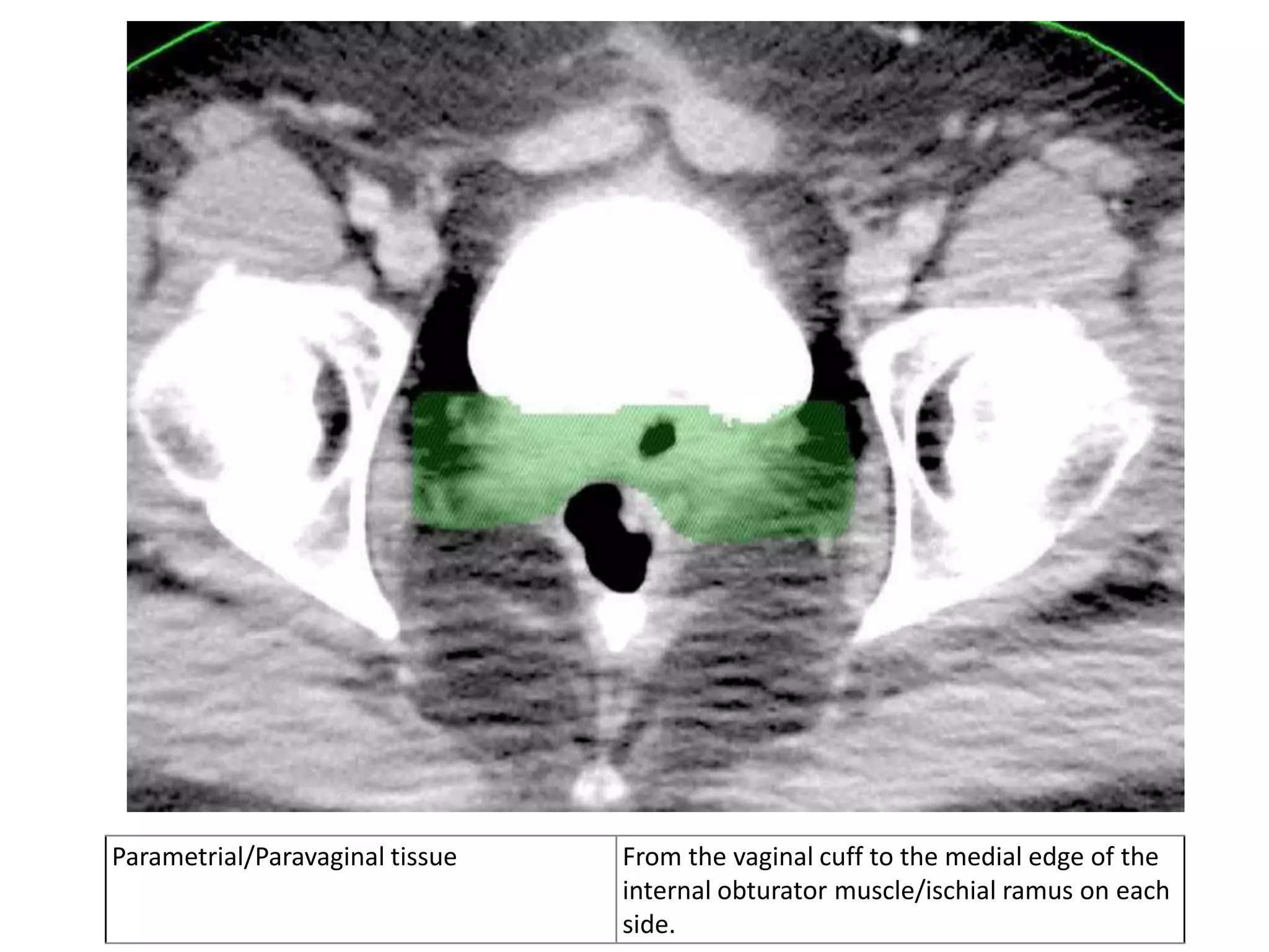 Lymphatics of the pelvis | PPTX