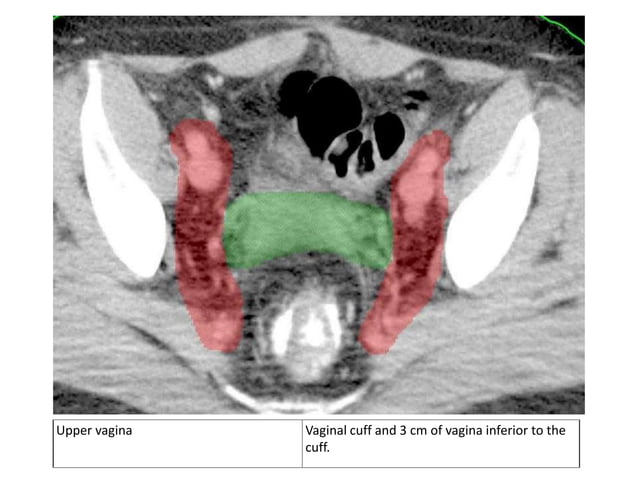 Lymphatics of the pelvis | PPTX