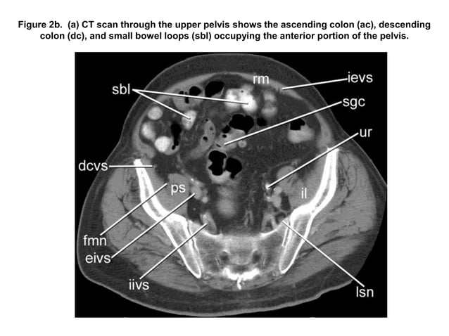 Lymphatics of the pelvis | PPTX