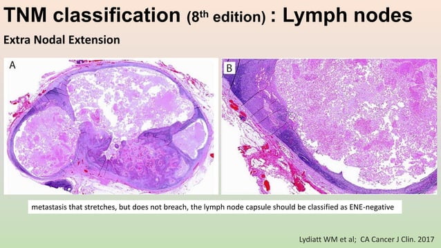 Lymphatic system of Head&Neck ; TNM Staging 8th edition | PPTX | Ear, Nose and Throat Conditions ...