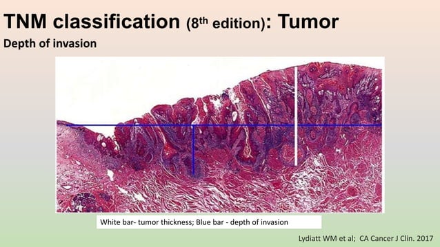 Lymphatic system of Head&Neck ; TNM Staging 8th edition | PPT