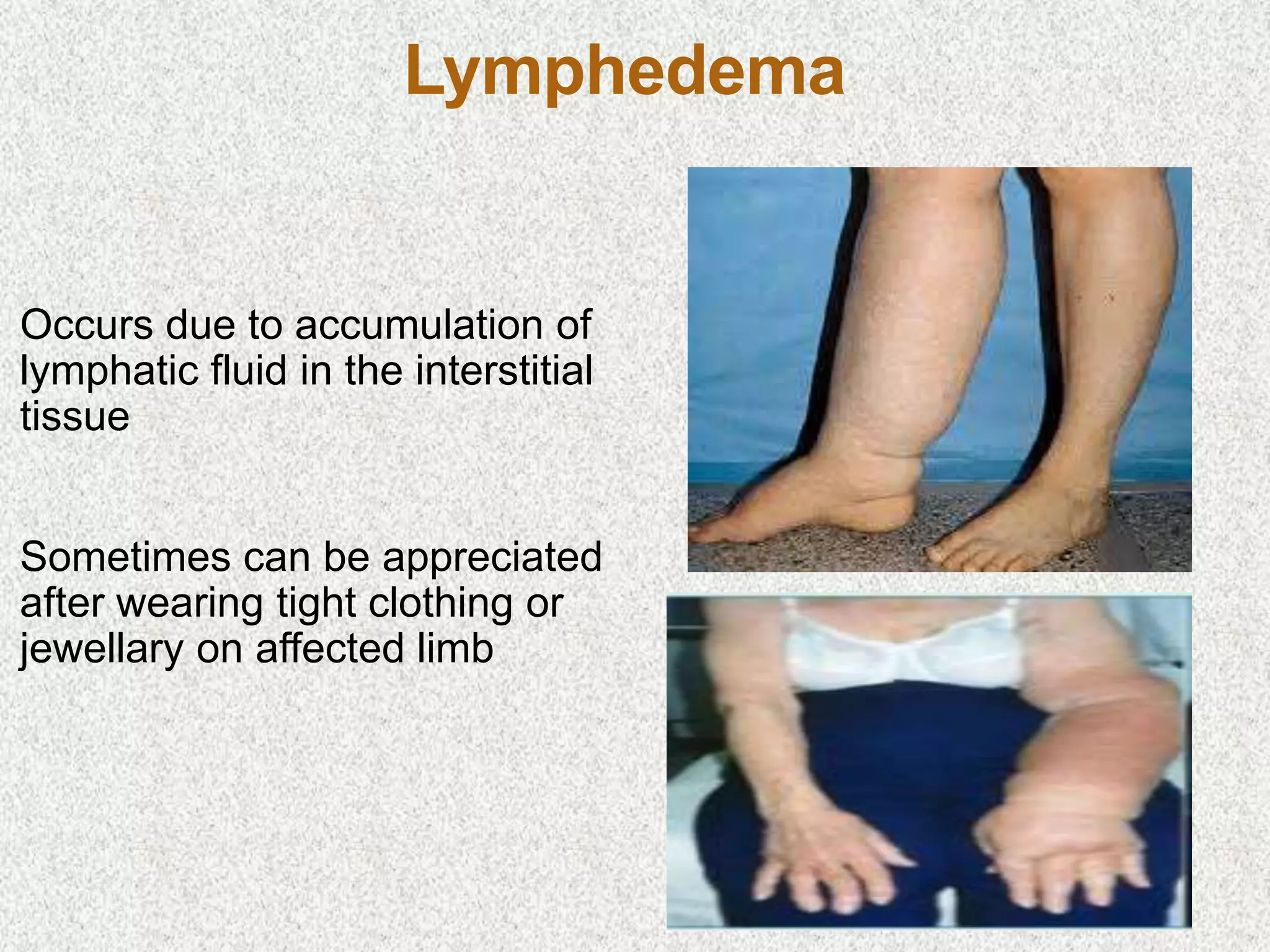 lymphatic_system | PPT