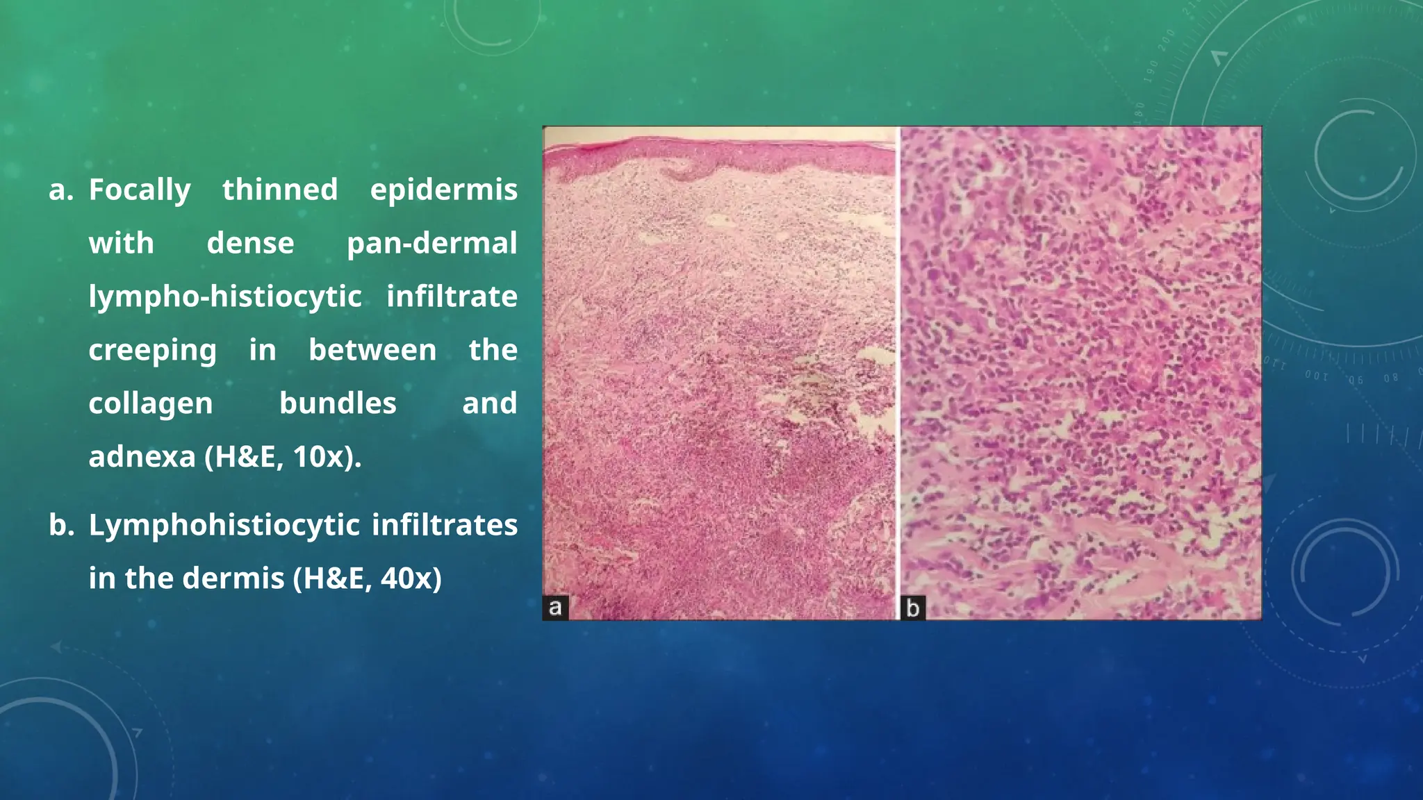 Lymphatoid Papulosis in dermatology diploma | PPT