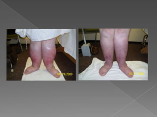 Lymphedema | PPTX