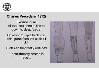 Trends in the management of Lymphedema | PPT