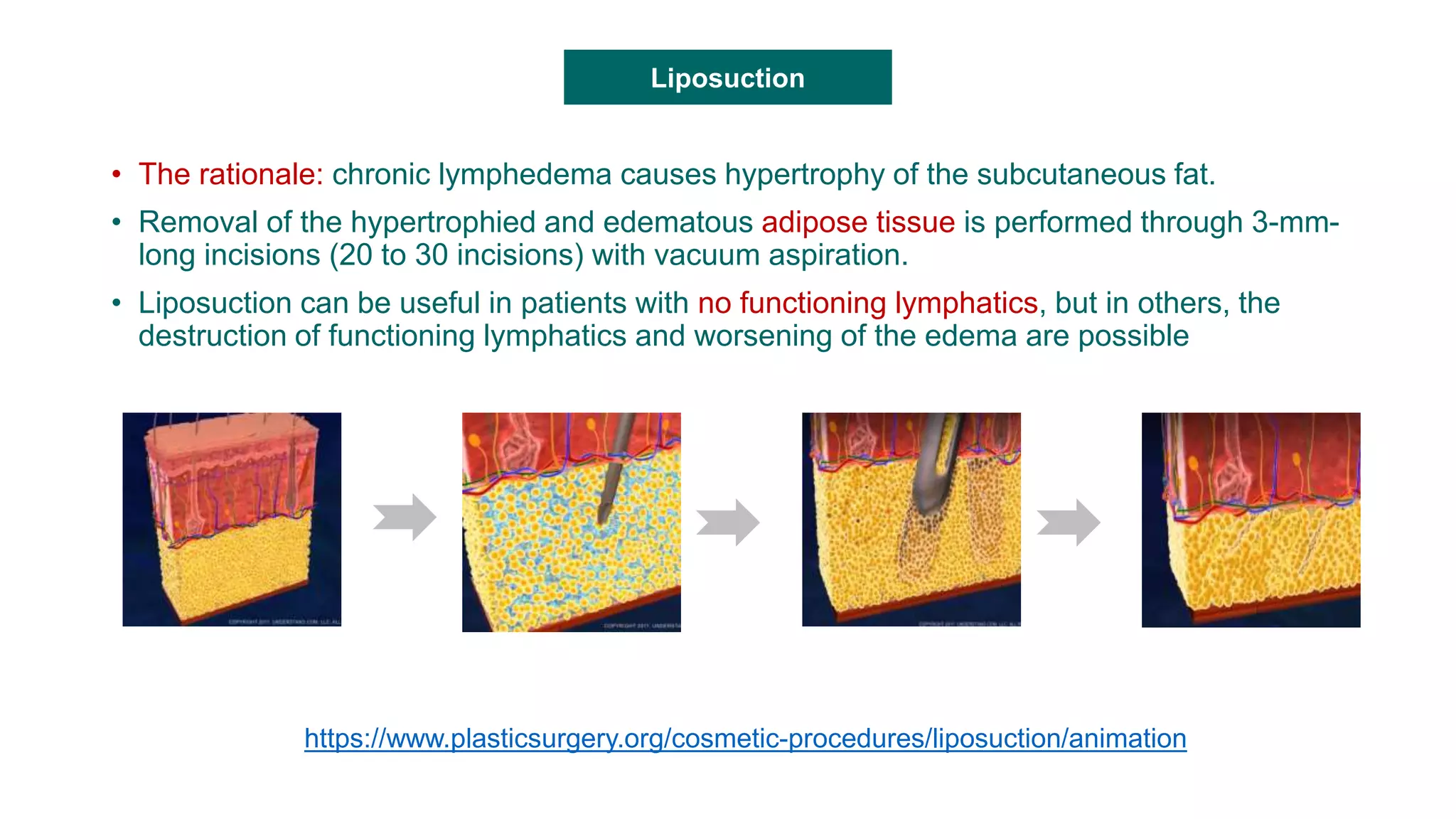 Lymphedema | PPTX