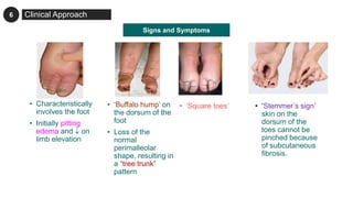 Lymphedema | PPTX