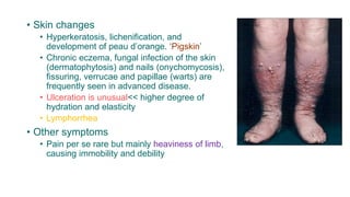 Lymphedema | PPTX