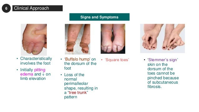 Lymphedema