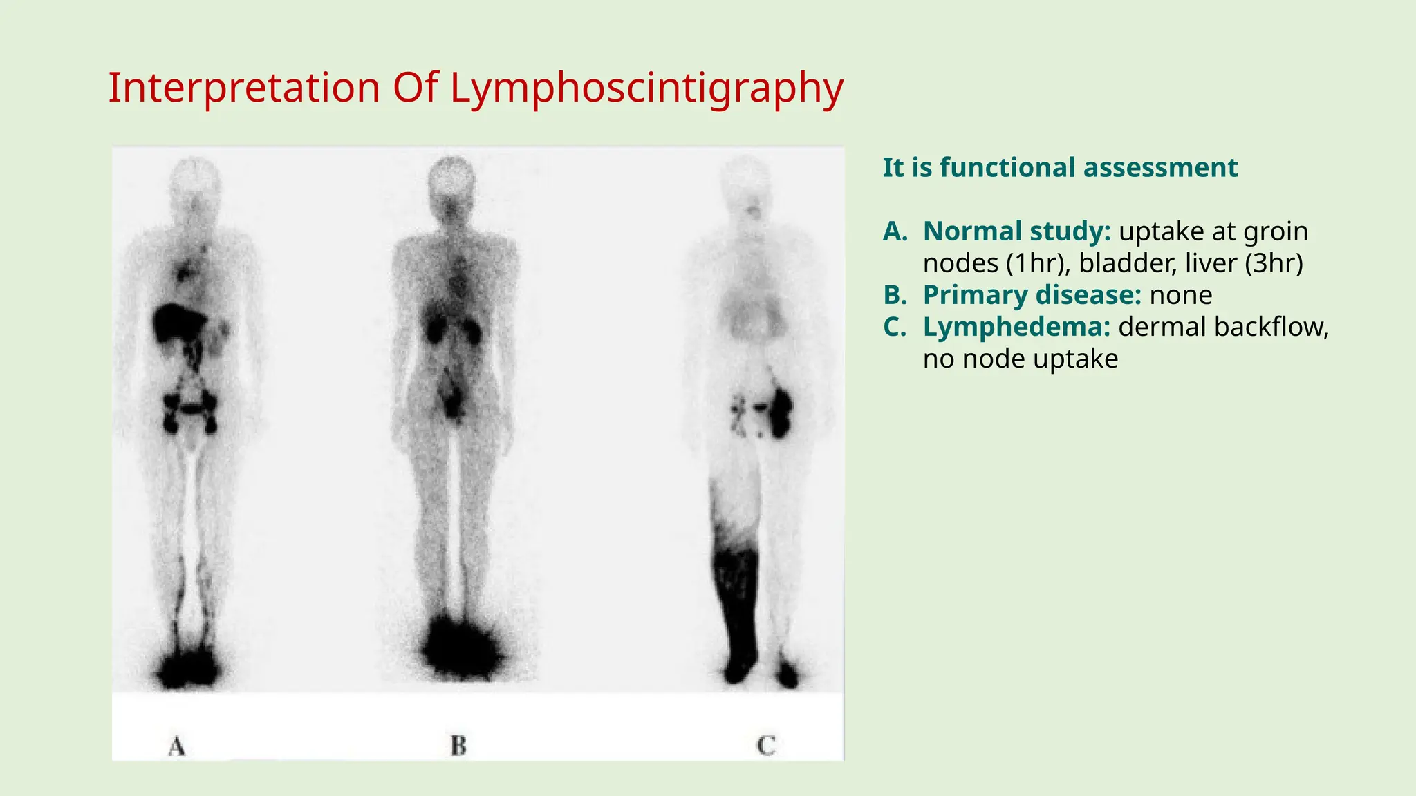 lymphedema internal medicine ppt presentation | PPTX