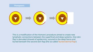 lymphedema internal medicine ppt presentation | PPTX