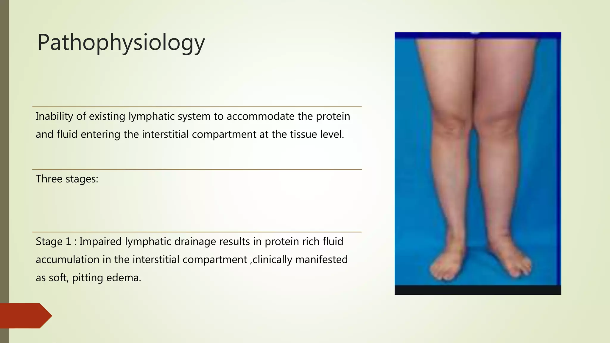 Lymphedema | PPTX
