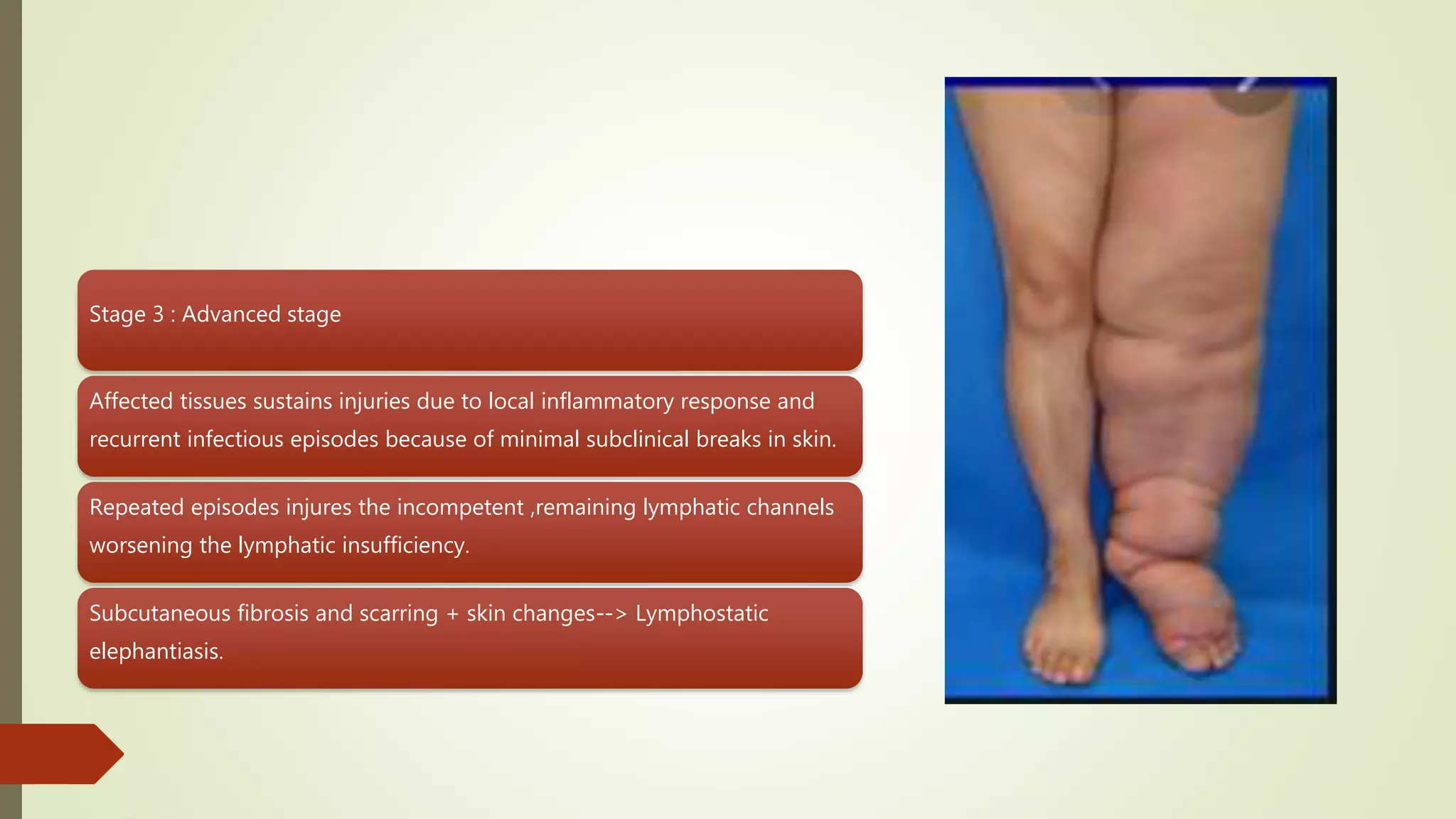 Lymphedema | PPTX