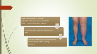 Lymphedema | PPTX