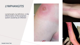 lymphedema, lymphangitis pathology .pptx